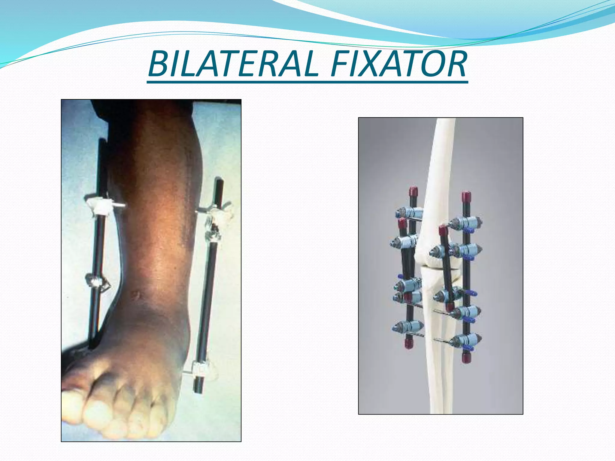 External, internal fixation, DCP and Cast Syndrome | PPTX