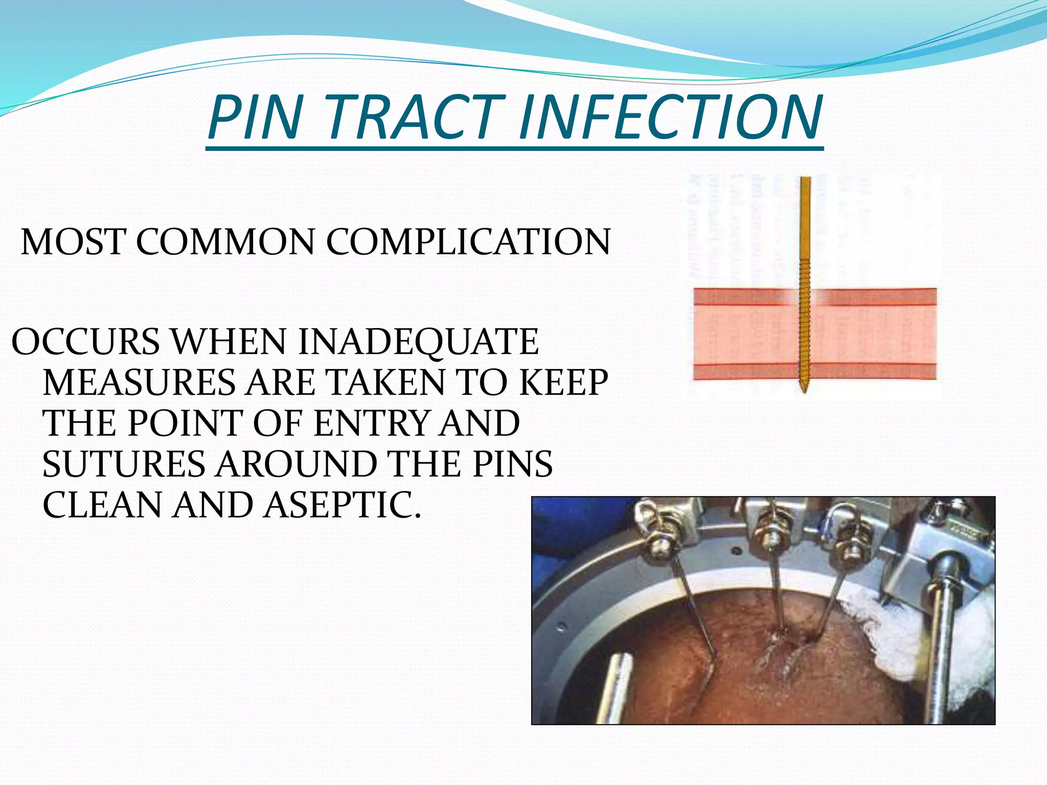 External, internal fixation, DCP and Cast Syndrome | PPTX