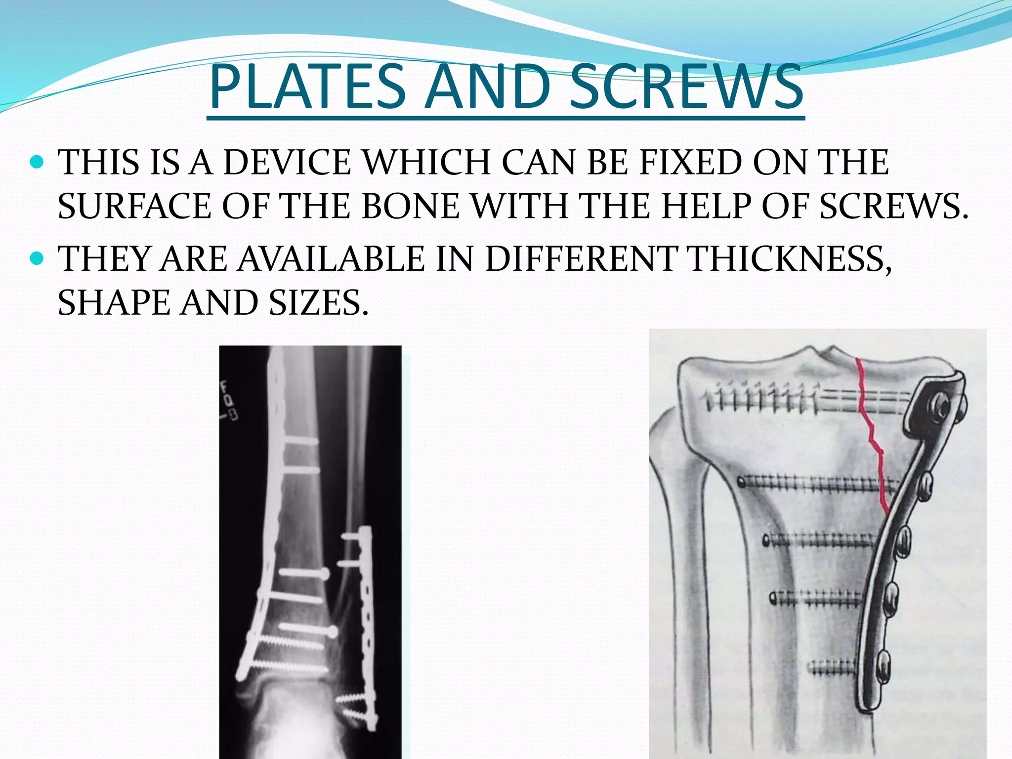 External, internal fixation, DCP and Cast Syndrome | PPTX
