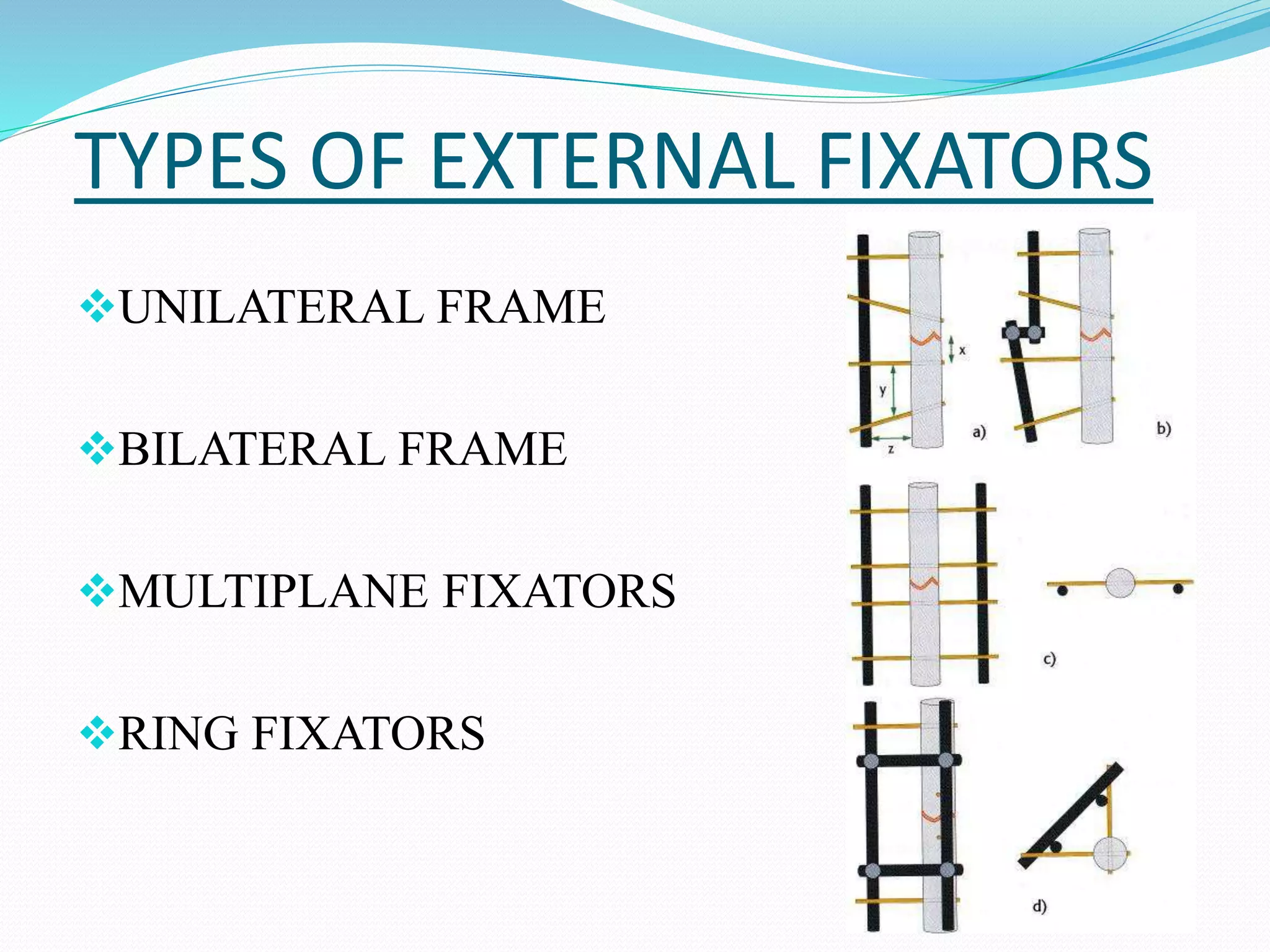 External, internal fixation, DCP and Cast Syndrome | PPTX