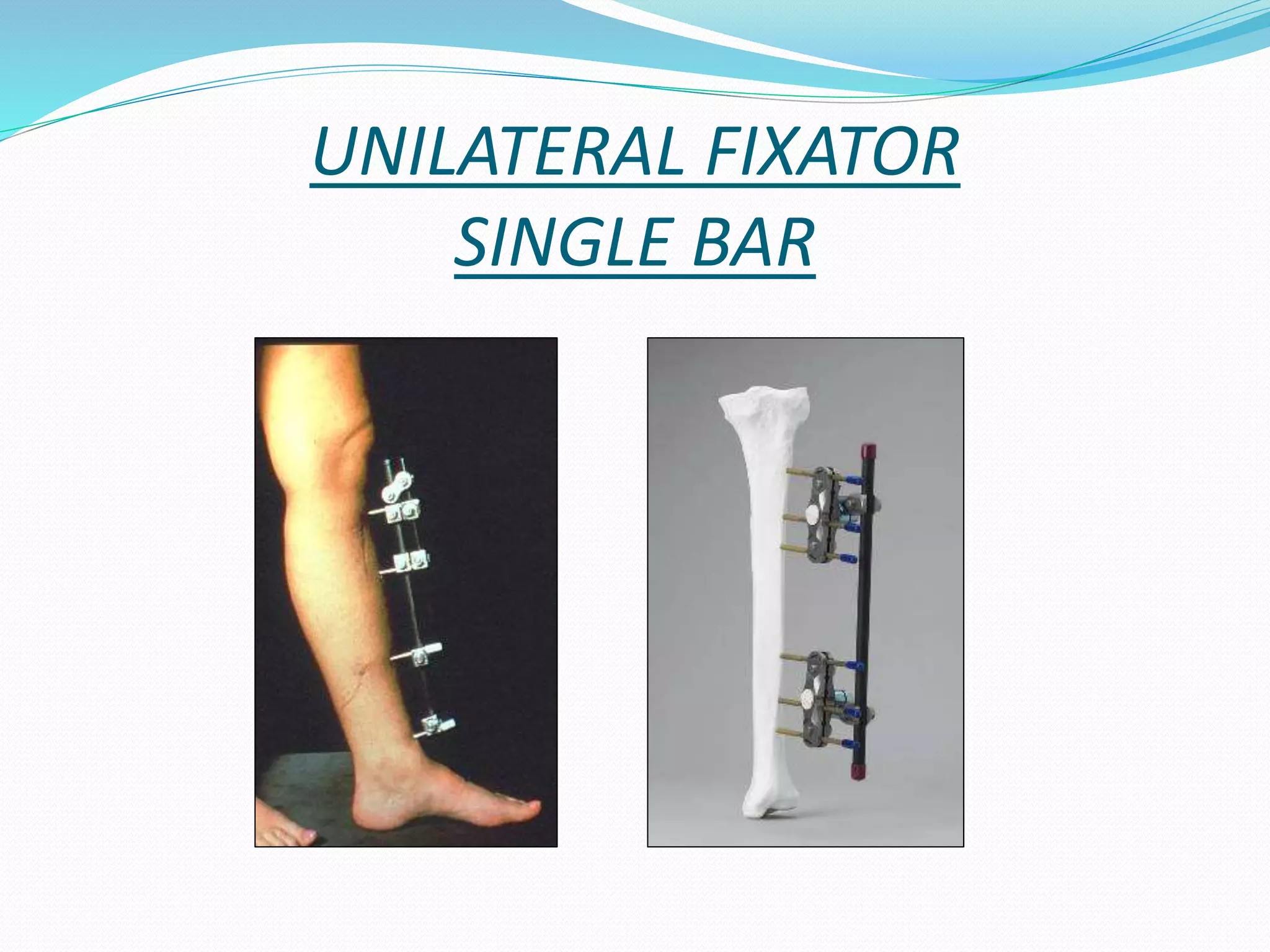 External, internal fixation, DCP and Cast Syndrome | PPTX