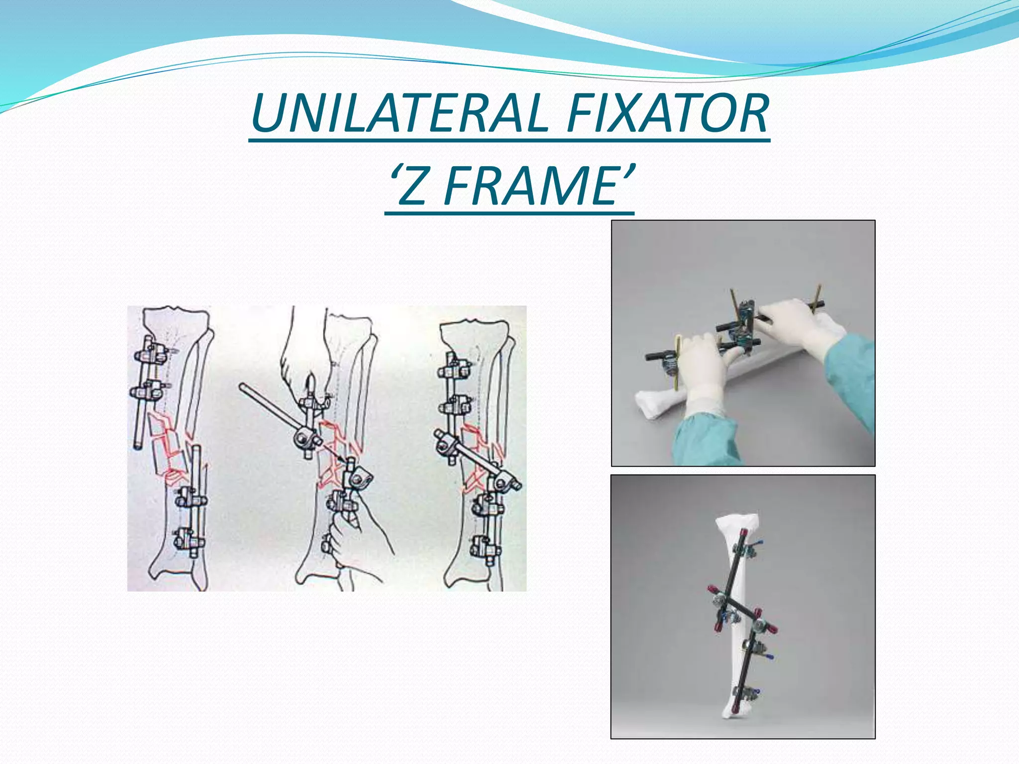External, internal fixation, DCP and Cast Syndrome | PPTX