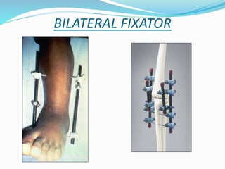 External, internal fixation, DCP and Cast Syndrome | PPTX