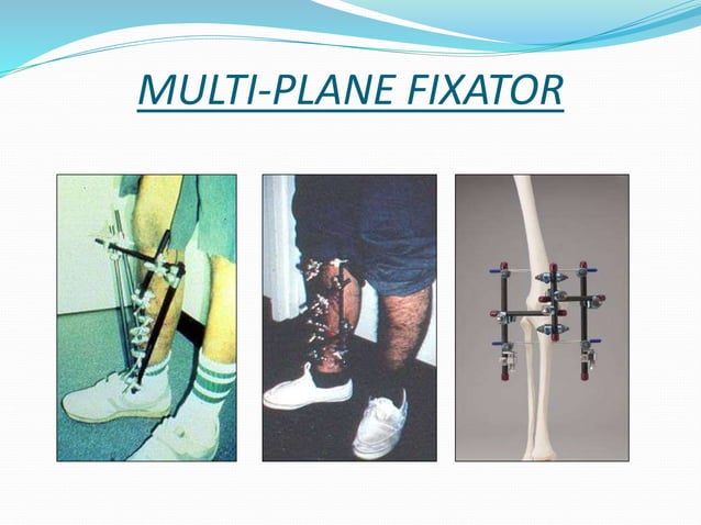 External, internal fixation, DCP and Cast Syndrome | PPTX