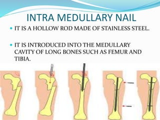 External, internal fixation, DCP and Cast Syndrome | PPTX