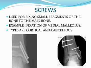 External, internal fixation, DCP and Cast Syndrome | PPTX