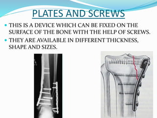 External, internal fixation, DCP and Cast Syndrome | PPTX