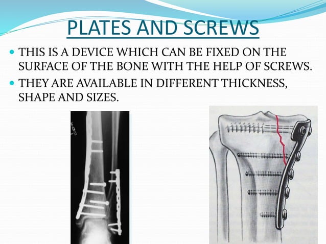 External, internal fixation, DCP and Cast Syndrome | PPTX