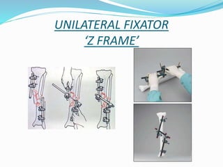 External, internal fixation, DCP and Cast Syndrome | PPTX