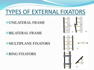 External, internal fixation, DCP and Cast Syndrome | PPT