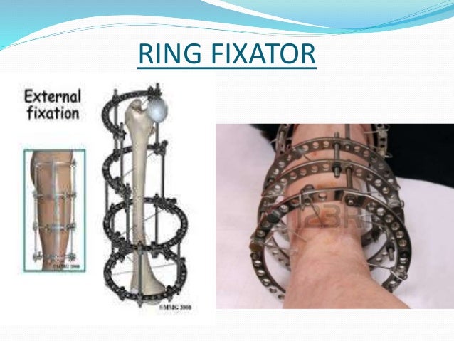 External, internal fixation, DCP and Cast Syndrome