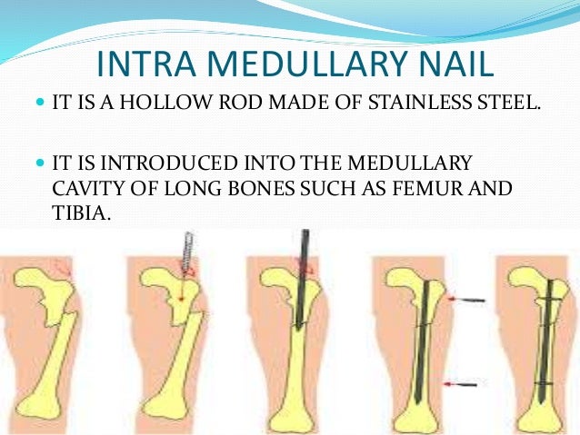 External, internal fixation, DCP and Cast Syndrome
