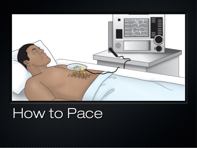 Using External Pacemaker