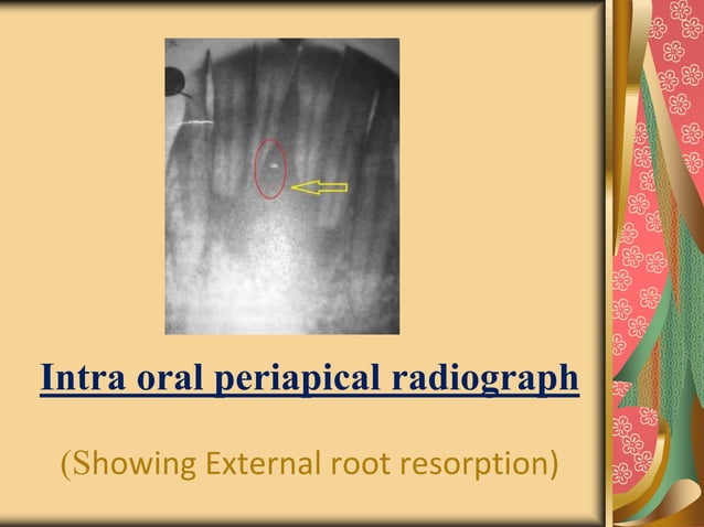 External resorption | PPT