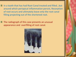 External resorption | PPT