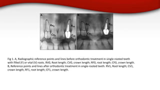 External Root Resorption During Orthodontic.pptx