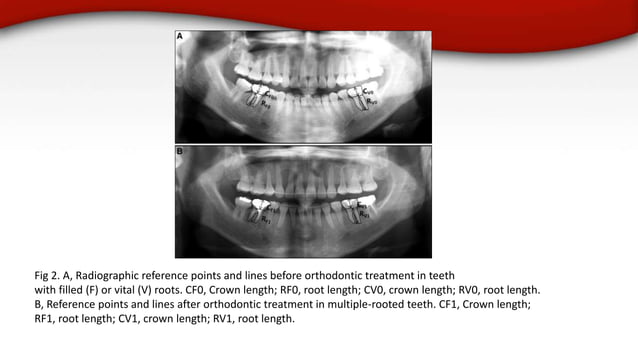 External Root Resorption During Orthodontic.pptx