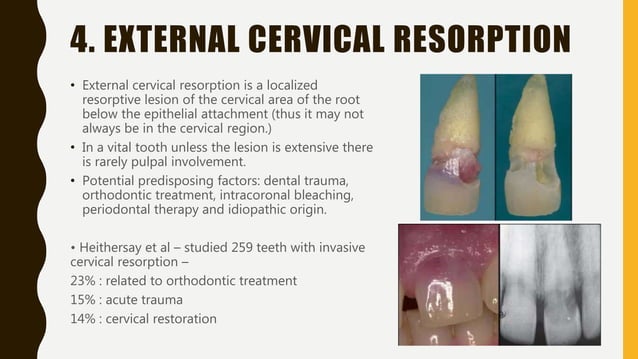 External root resorption (ERR) | PPTX | Dental Health | Diseases and Conditions