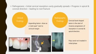External root resorption (ERR) | PPTX