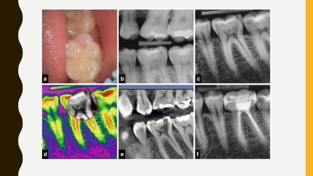 External root resorption (ERR) | PPTX | Dental Health | Diseases and ...