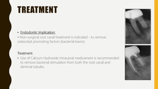 External root resorption (ERR) | PPTX