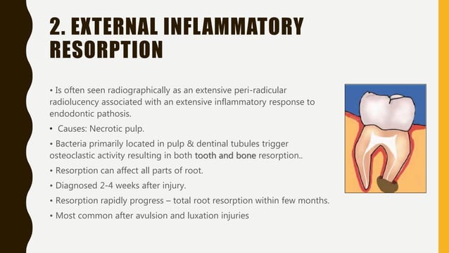 External root resorption (ERR)