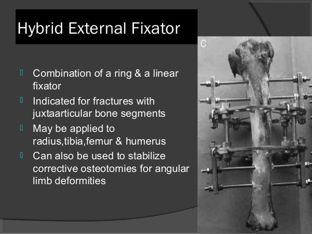 Fixator Anatomy Definition External Fixator