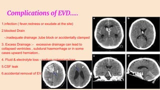 EXTERNAL VENTRICULAR CARE FOR NURSES.pptx