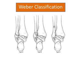 Extern conference Ankle Fracture JOE | PPT