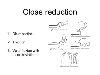 Distal end of Radius Fractures | PPTX