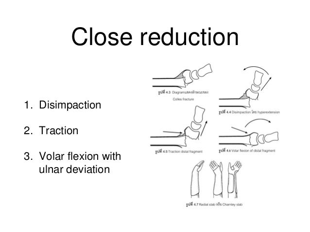 The Amount And Related Factors Of Reduction Loss In Distal Radius
