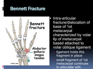 Rolando Fracture | PPTX
