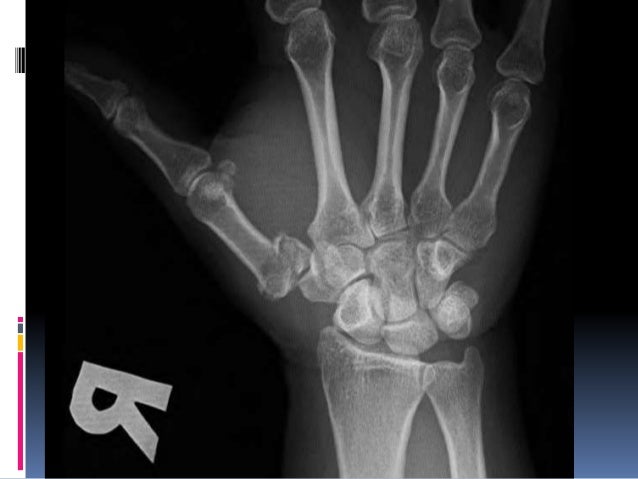Rolando Fracture
