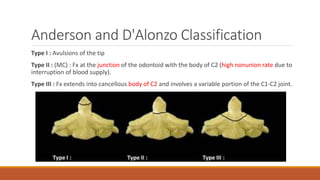 Extern Conference Odontoid Fracture | PPT