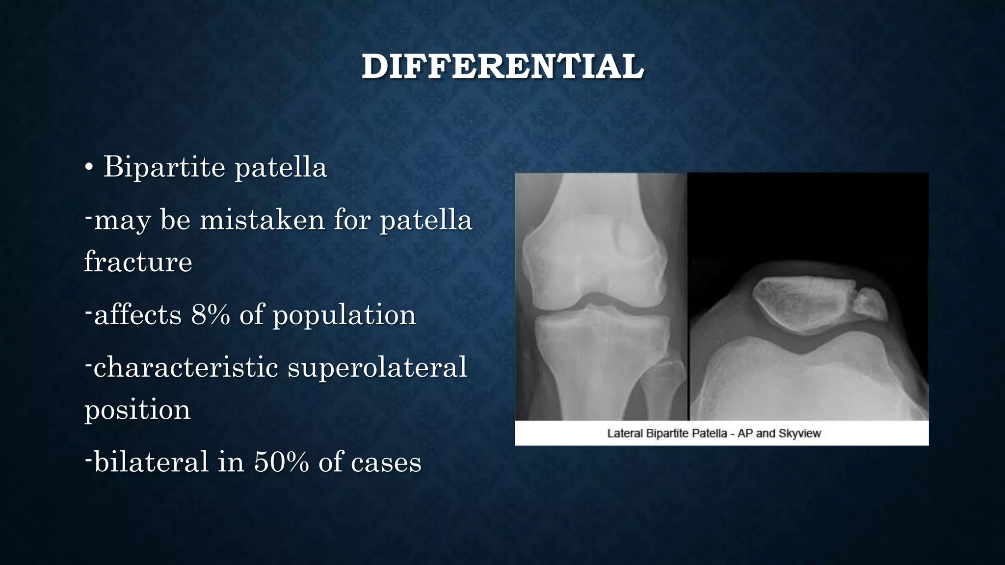 Extern ortho patella fracture | PPTX