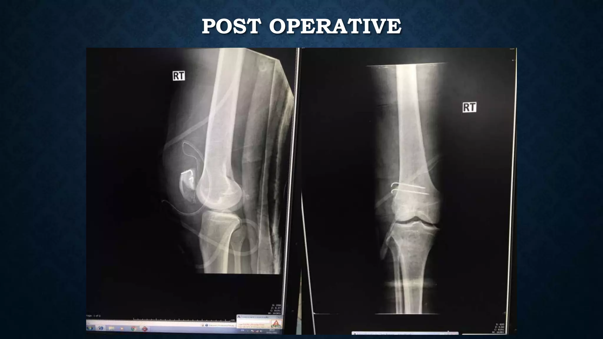 Extern ortho patella fracture | PPTX