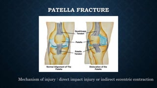 Extern ortho patella fracture | PPTX