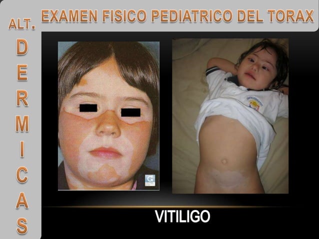 Examen Torax Pediatrico Inspeccion y Palpacion | PPTX