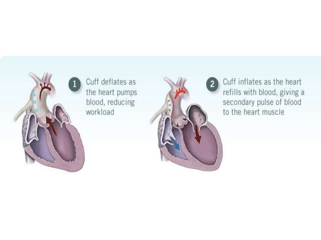 Extra aortic balloon counterpulsation | PPT