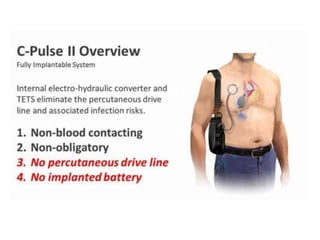 Extra aortic balloon counterpulsation | PPTX