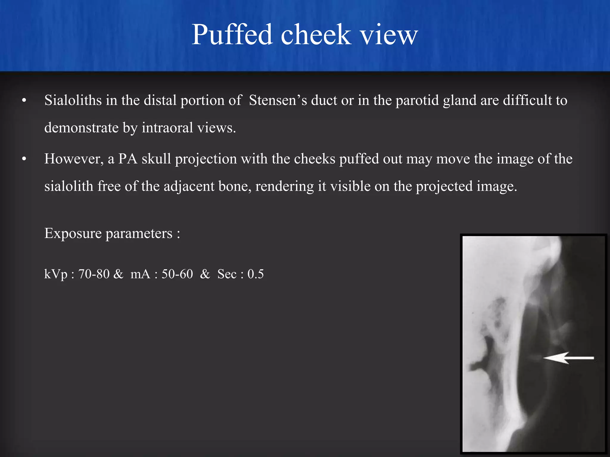 Extra oral radiographic techniques | PPTX