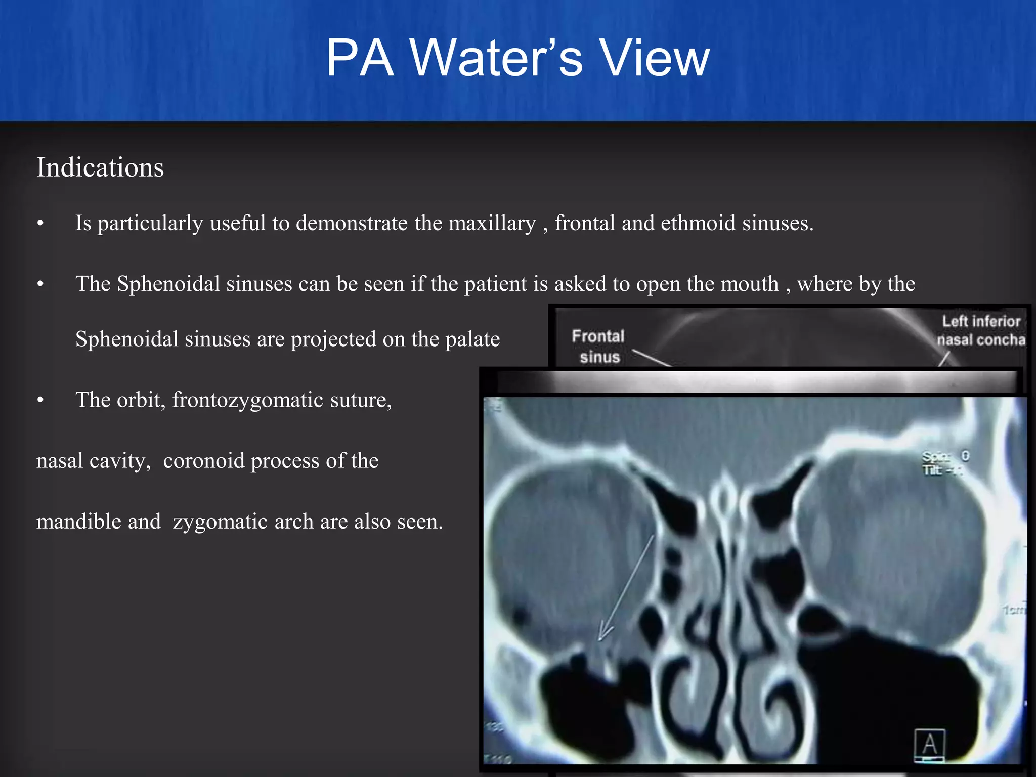 Extra oral radiographic techniques | PPTX