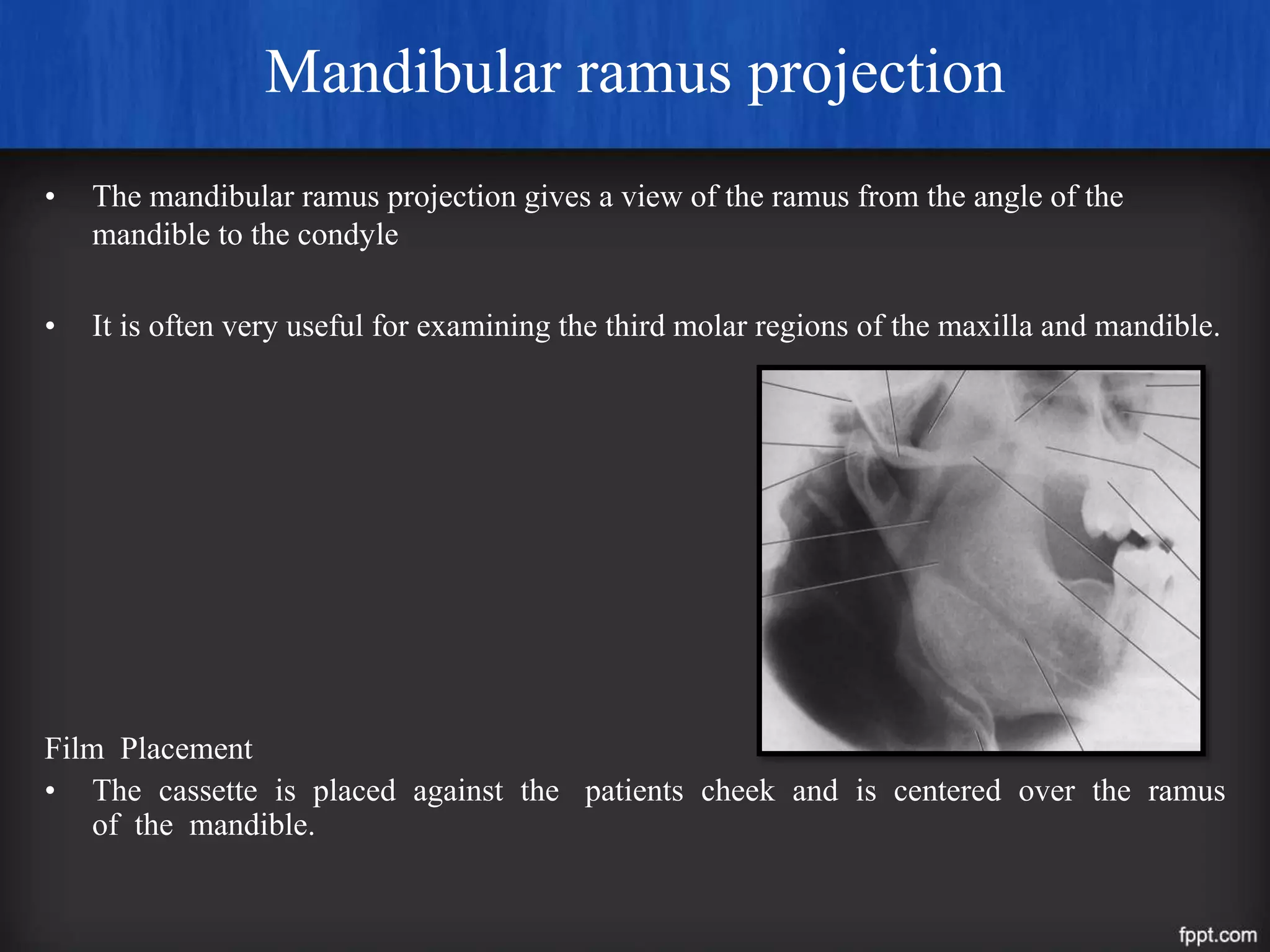 Extra oral radiographic techniques | PPTX