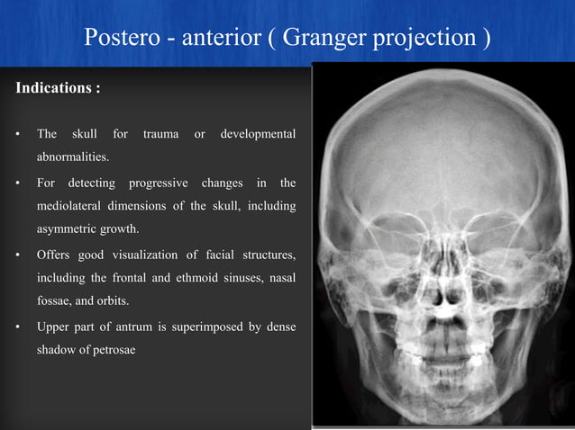 Extra oral radiographic techniques | PPTX | Dental Health | Diseases ...
