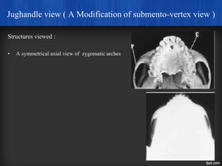 Extra oral radiographic techniques | PPTX