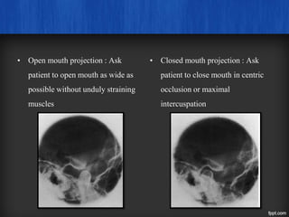 Extra oral radiographic techniques | PPTX