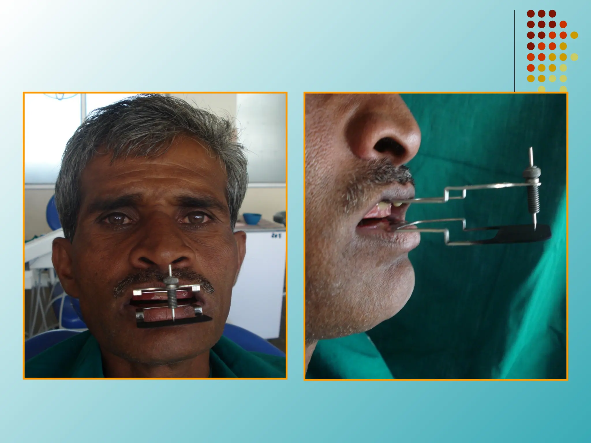 extra and intra oral traces.ppt PROSTHODONTICS | PPT