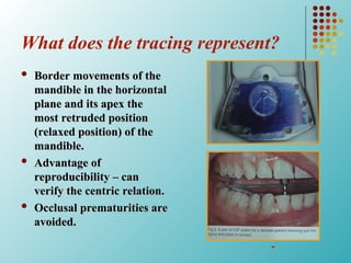 extra and intra oral traces.ppt PROSTHODONTICS | PPT