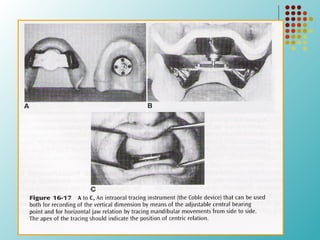 extra and intra oral traces.ppt PROSTHODONTICS | PPT