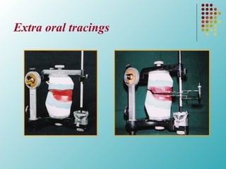 extra and intra oral traces.ppt PROSTHODONTICS | PPT